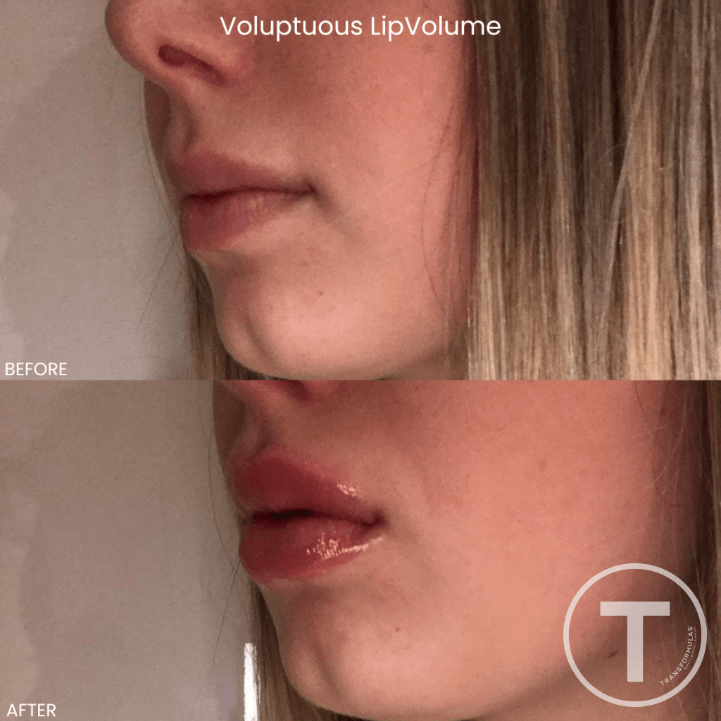 FaceFixers Voluptuous LipVolume | Transformulas
